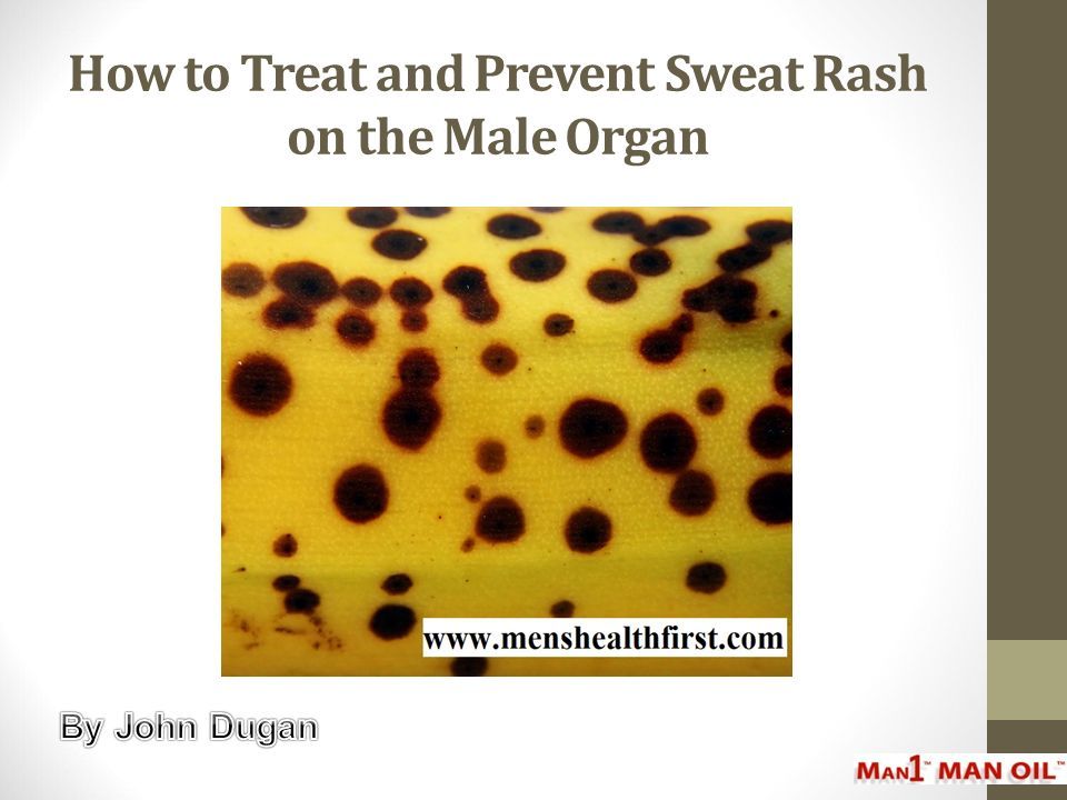 How To Treat And Prevent Sweat Rash On The Male Organ Ppt Download